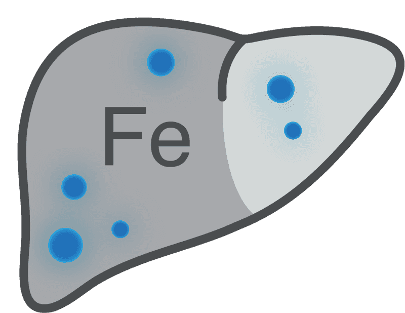 Understanding Hemochromatosis: What Is Iron Overload? | NYGA